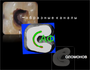Экстрим в эндодонтии или С-образные каналы - EndoSchool